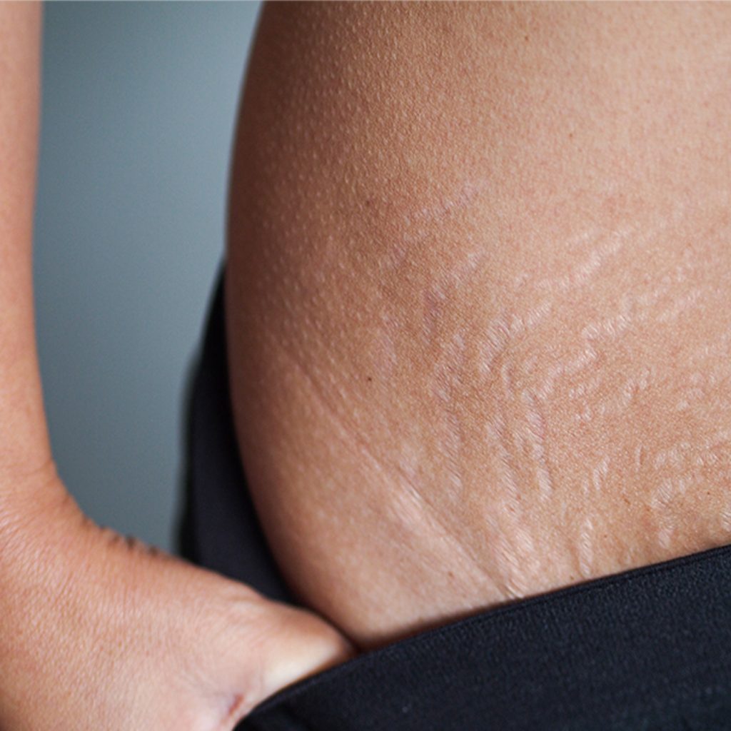 Radiofrequency Microneedling (RF) - Body Sagginess Treatment