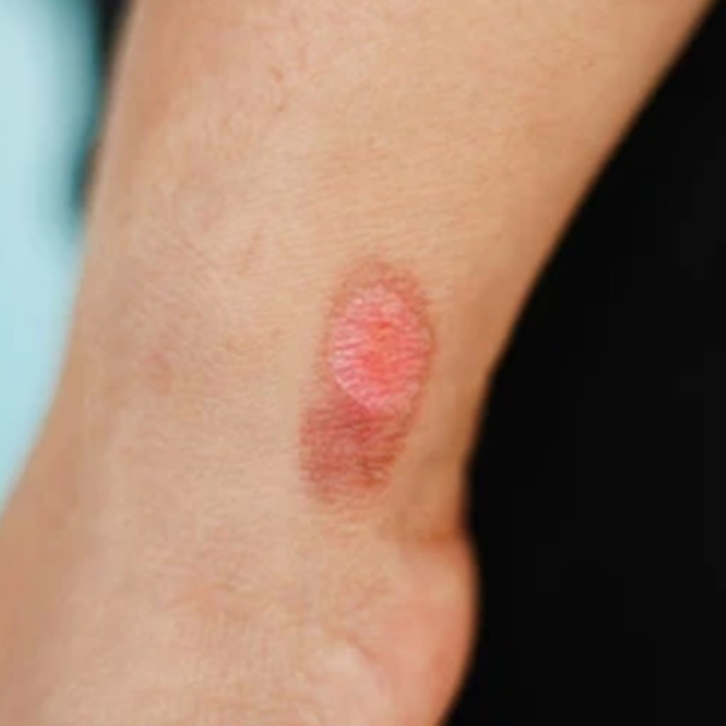 First Degree Burn Treatment Abu Dhabi - Everlast Wellness