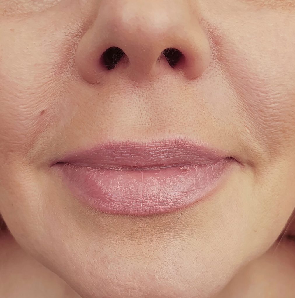 Lip Wrinkle Treatment Abu Dhabi - Lip Filler, Laser Lip Rejuvenation