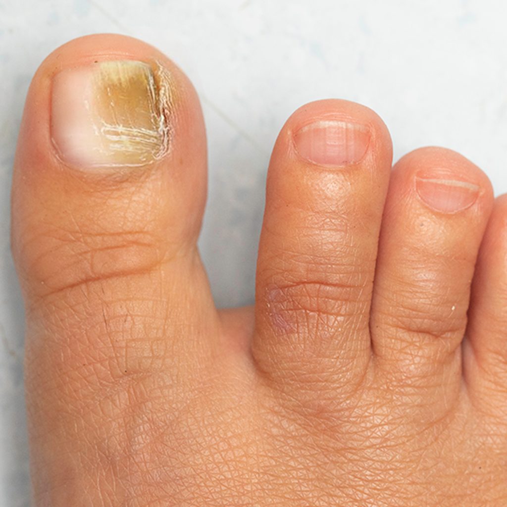 Nail Fungal Treatment Abu Dhabi - Nail Infection Treatment