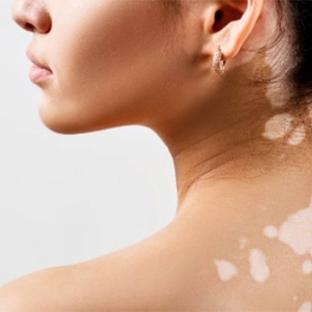 Vitiligo Treatment in Dubai, Abu Dhabi - Causes And Indications