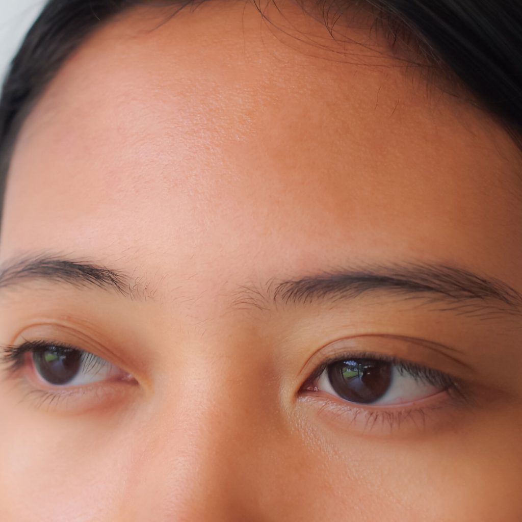 Whiteheads Removal, Treatment, Causes And Indications