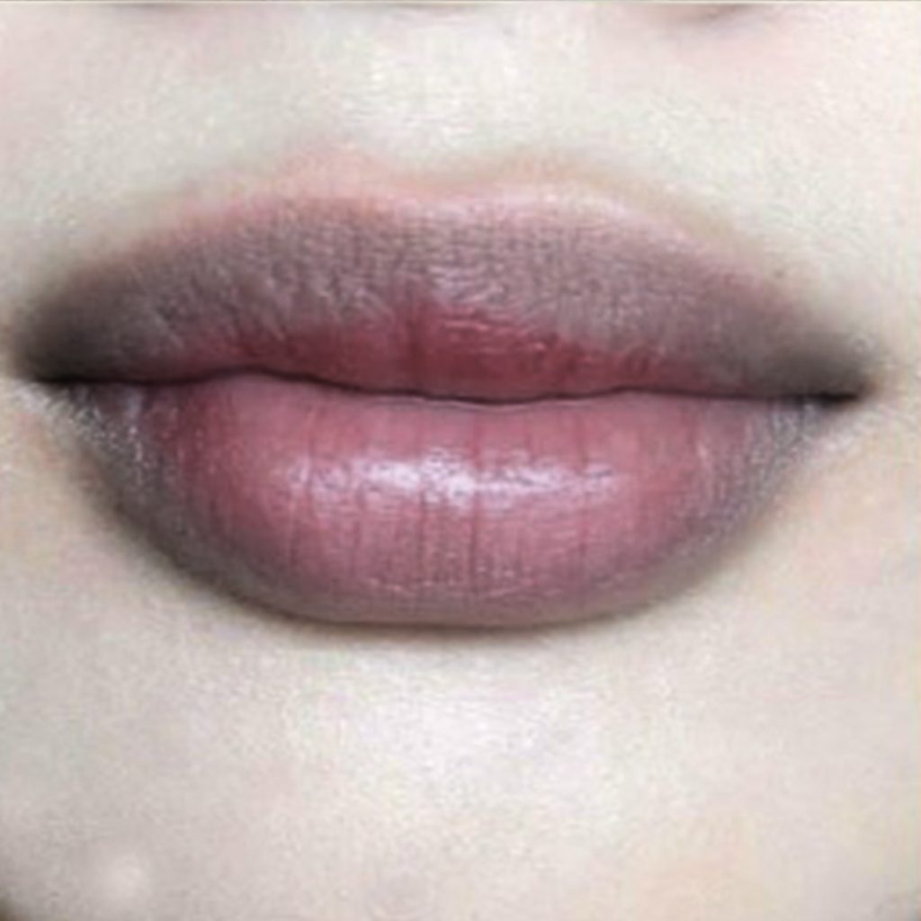 Best Dark Lips Treatment Abu Dhabi - Laser Treatment Abu Dhabi