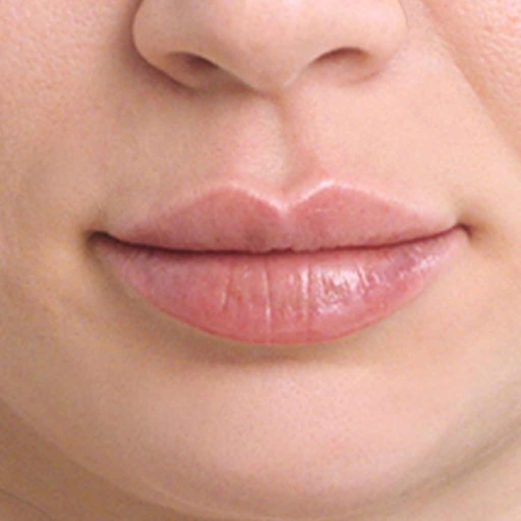 Best Lip Fillers Abu Dhabi - Lip Volume Loss - Everlast Wellness