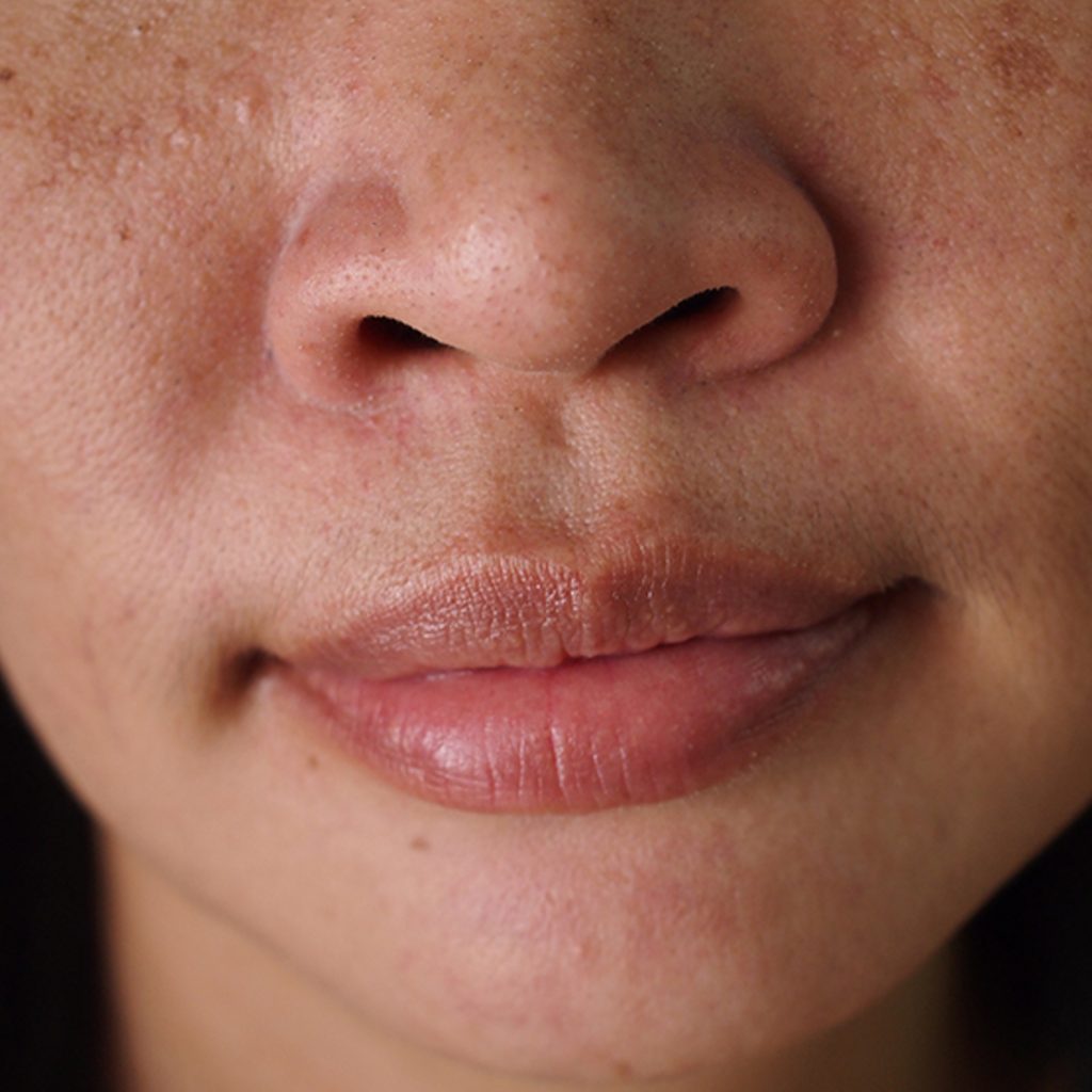 Sun Damaged Skin Treatment - Carbon Laser, Laser Resurfacing
