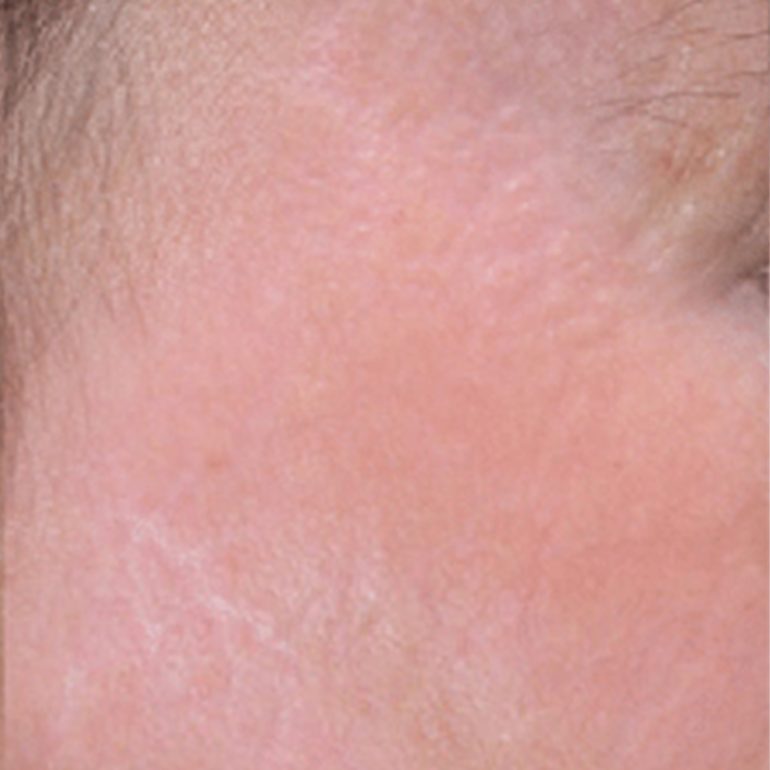 Atrophic Scars Treatment Abu Dhabi - Everlast Wellness Medical