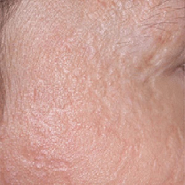 Atrophic Scars Treatment Abu Dhabi - Everlast Wellness Medical