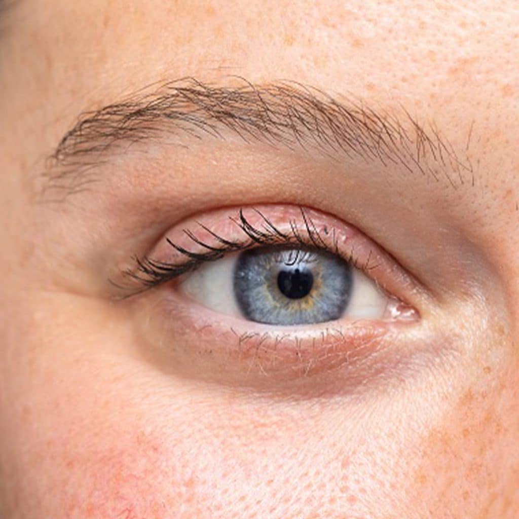 Drooping Eye Lids - Everlast Wellness Medical Center