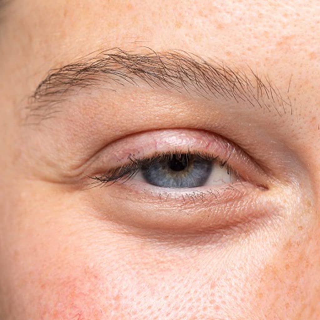 Drooping Eye Lids - Everlast Wellness Medical Center