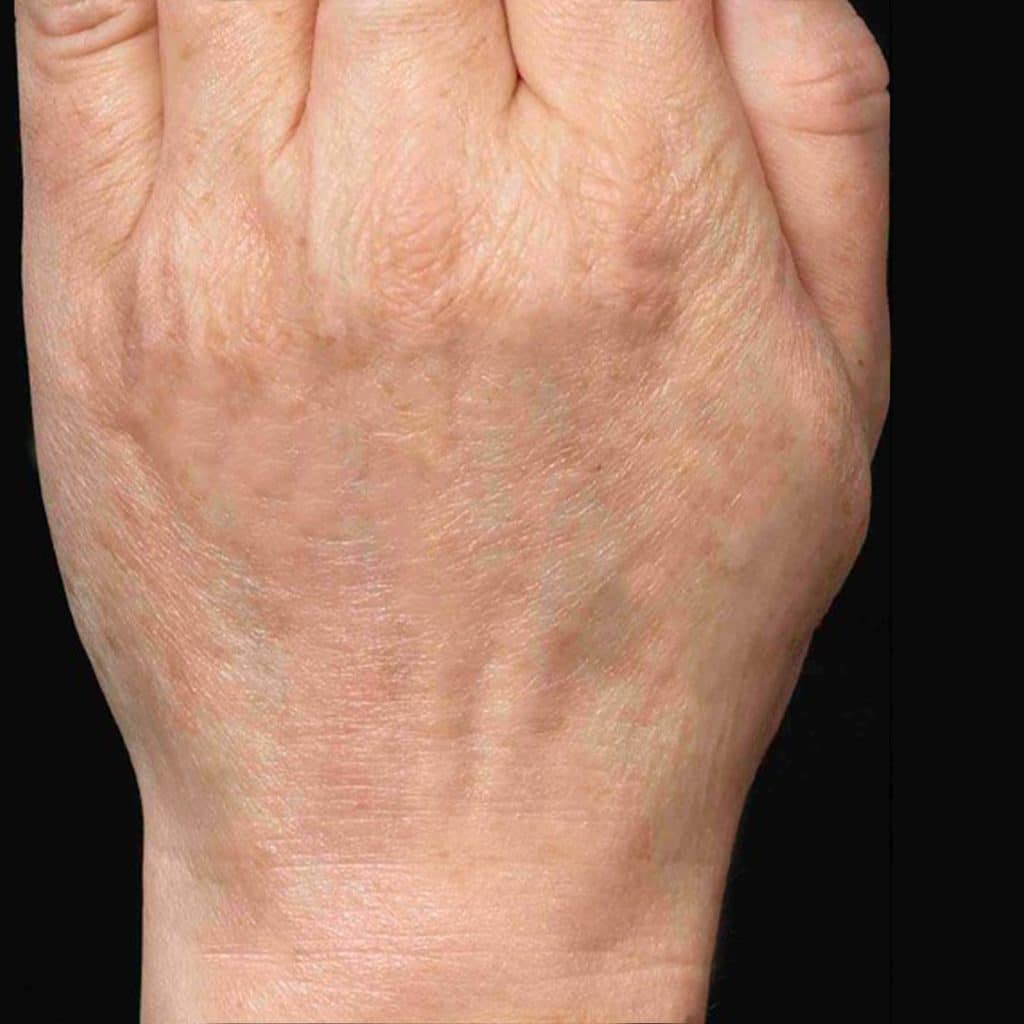 Hyperpigmentation Treatment in Abu Dhabi - Best Dermatologist