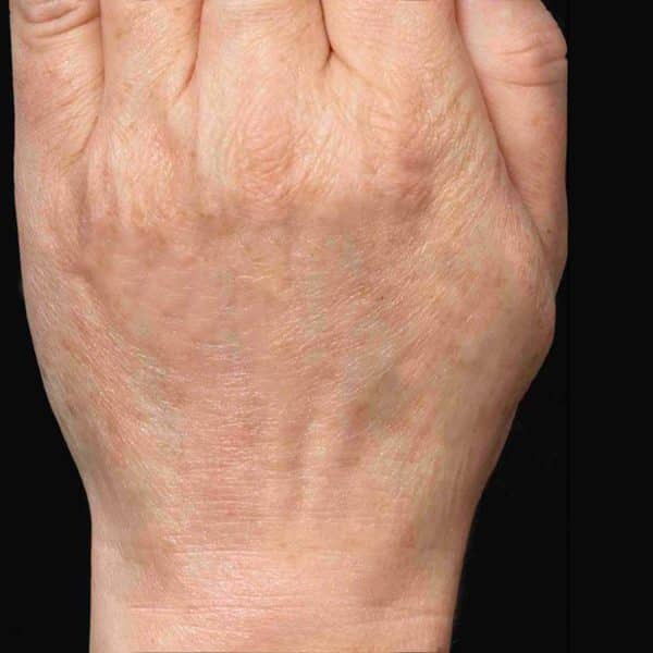 Hyperpigmentation Treatment in Abu Dhabi - Best Dermatologist